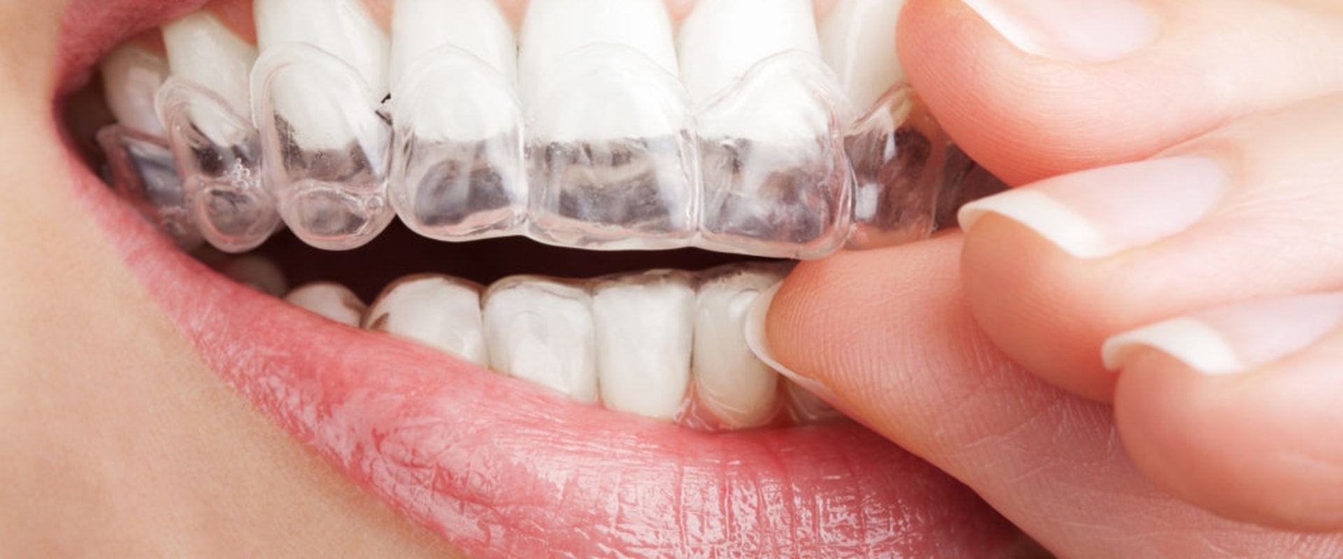 Can Invisalign Retainers Be Adjusted?