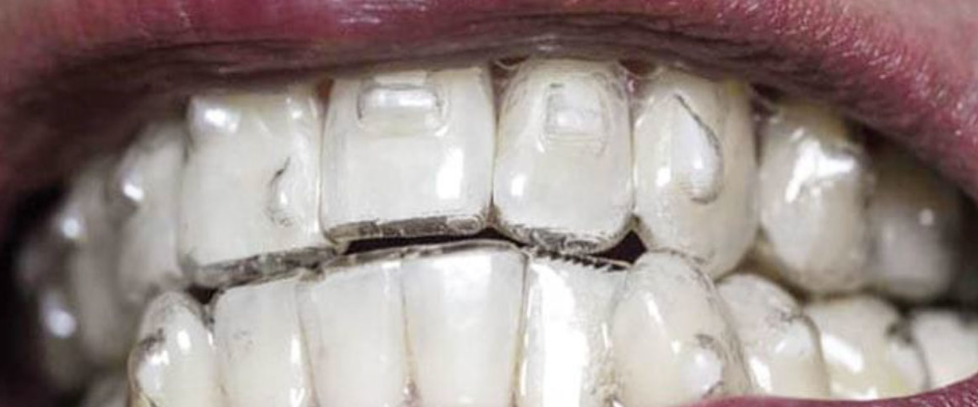 Do Invisalign Attachments Always Need to be Used?