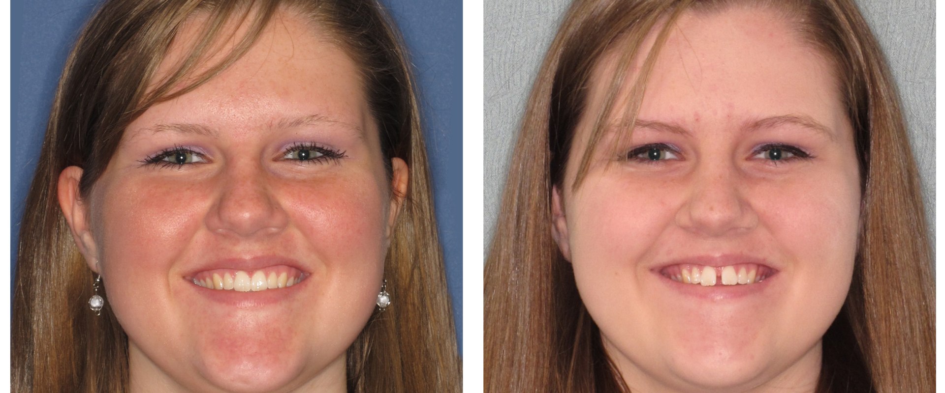 Will Invisalign Change My Face?